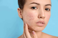 What Is Cystic Acne Treatment And Prevention Gopuff What Is Cystic Acne Treatment And Prevention Gopuff