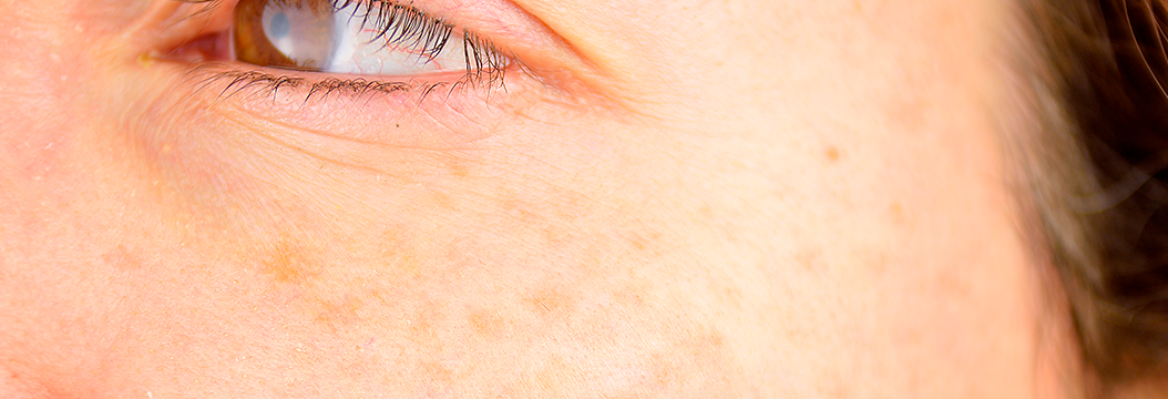 ¿Cómo cuidar la piel de las manchas del sol? – Pomys