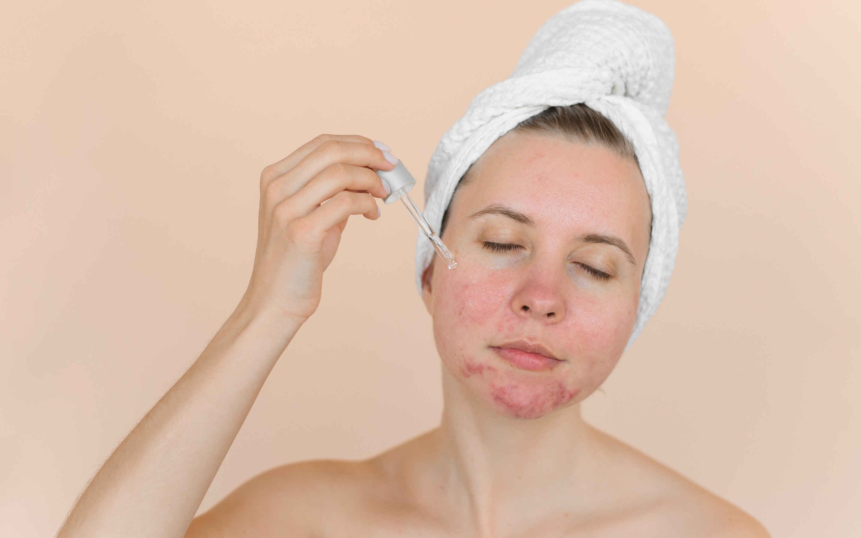 Traitement de l'acné adulte : que faire ? - Aroma-Zone