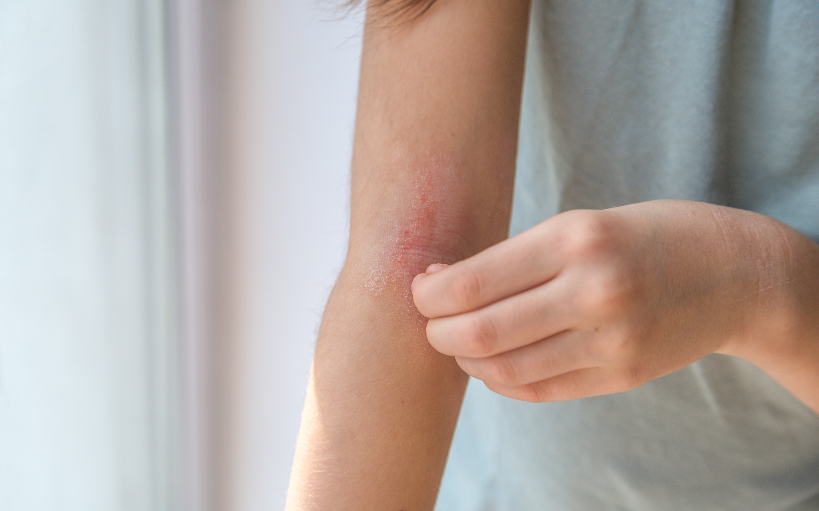 Piqûre d'aoûtat : comment la reconnaitre et la soulager ? - Aroma-Zone