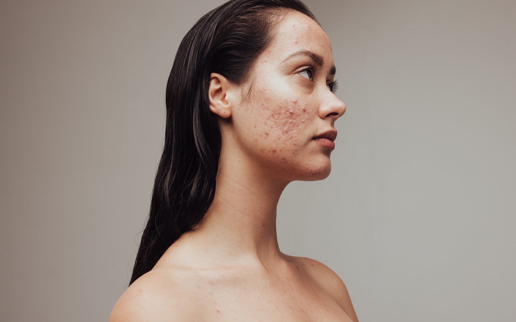 Acné rétentionnelle : causes & solutions naturelles - Aroma-Zone