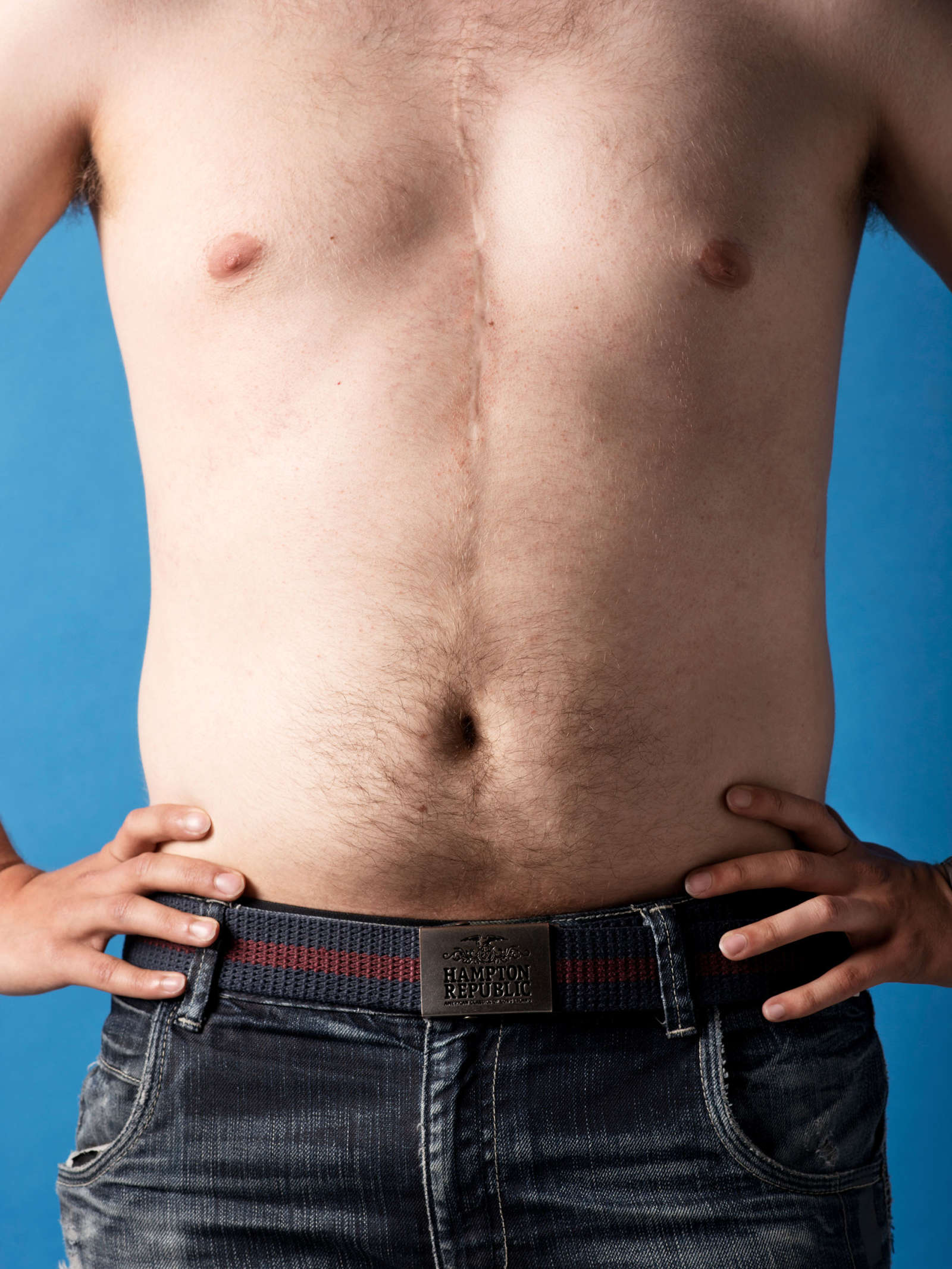 Mouruaako mahassa? Toiminnallinen vatsavaiva on ikävä seuralainen ...