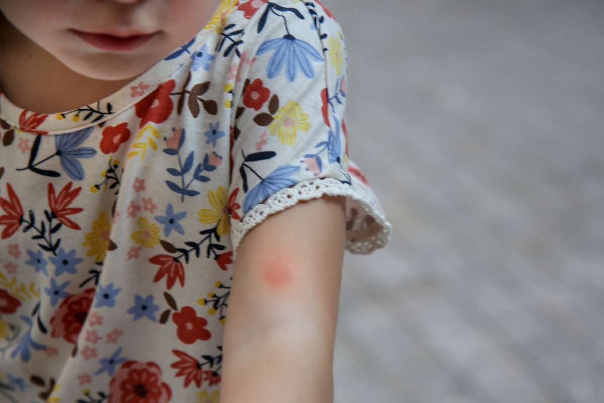 Bug Bite Relief: How to Treat Itching, Stinging & More