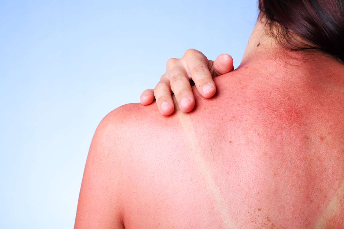 How To Treat A Sunburn
