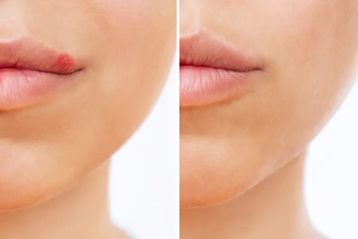 6 Ways to Get Rid of Cold Sores Fast: Medication & More