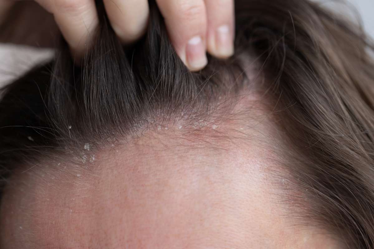 Scalp Psoriasis vs Dandruff: How Do I Tell The Difference?