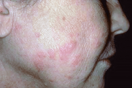 Lupus and your skin: Signs and symptoms