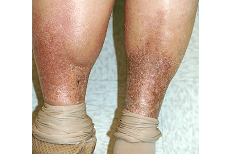 Eczema types: Stasis dermatitis signs and symptoms