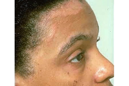 Seborrheic dermatitis: Signs and symptoms
