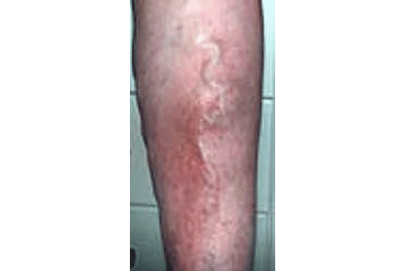 Eczema types: Stasis dermatitis overview