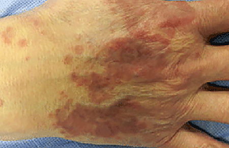 Granuloma annulare: Signs and symptoms