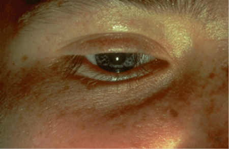 Hair loss types: Alopecia areata signs and symptoms