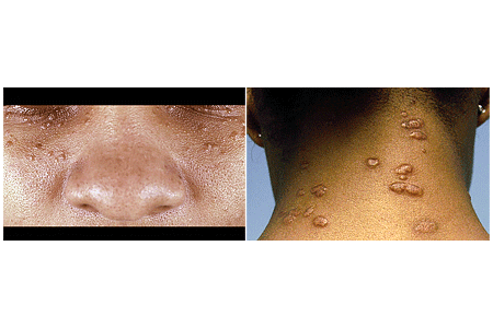 Sarcoidosis and your skin: Signs and symptoms