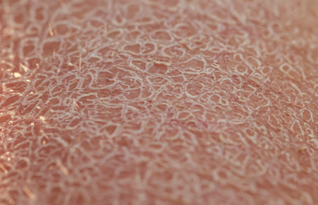 Dry skin: Signs and symptoms