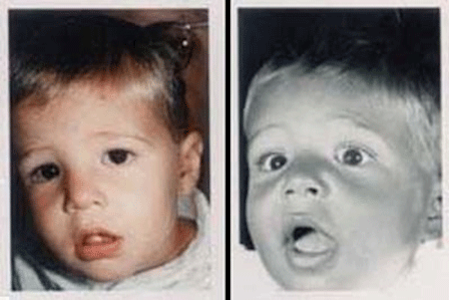 UV photography shows hidden sun damage