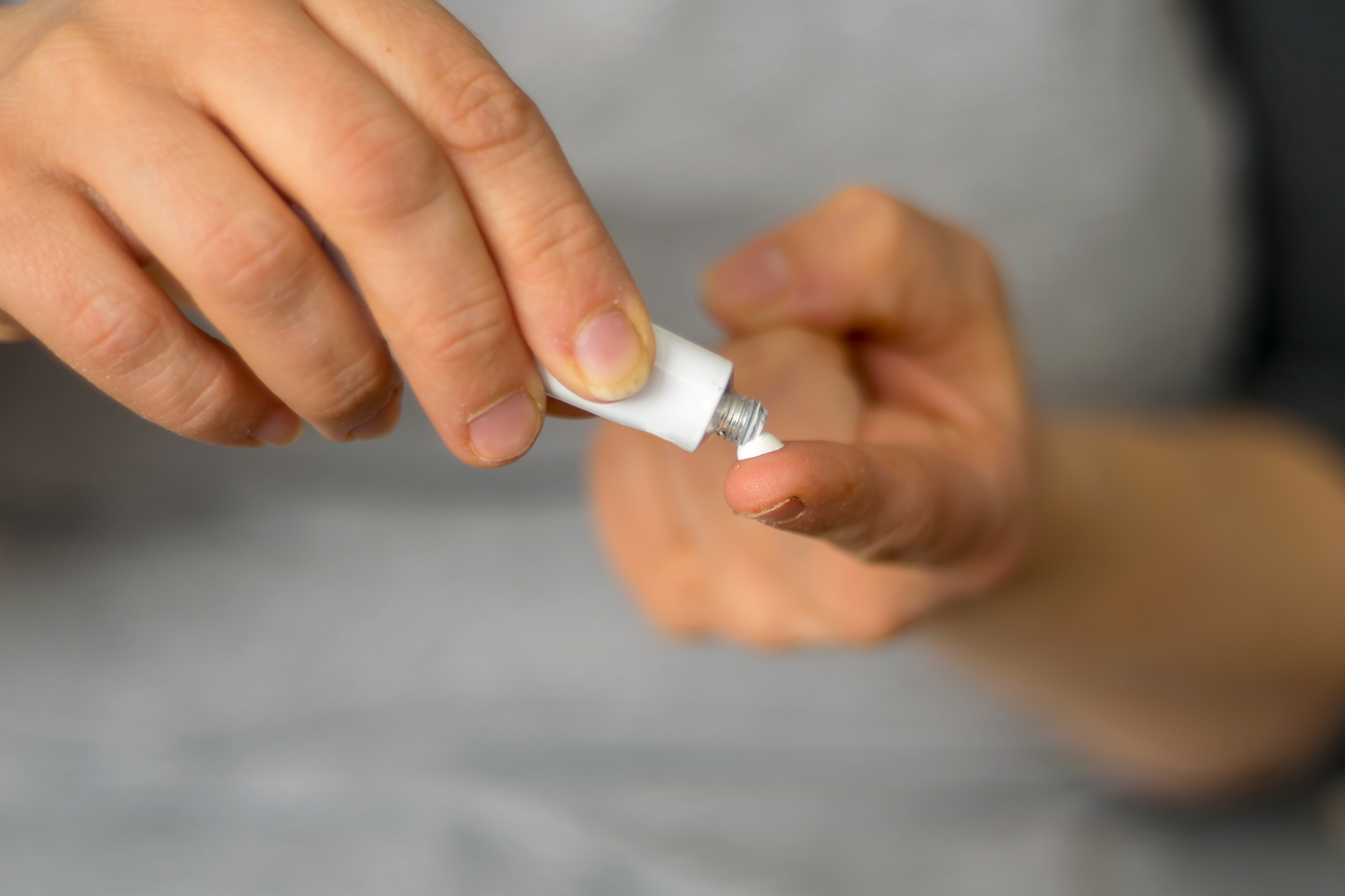 What strategies can be used to counter steroid phobia in patients being ...