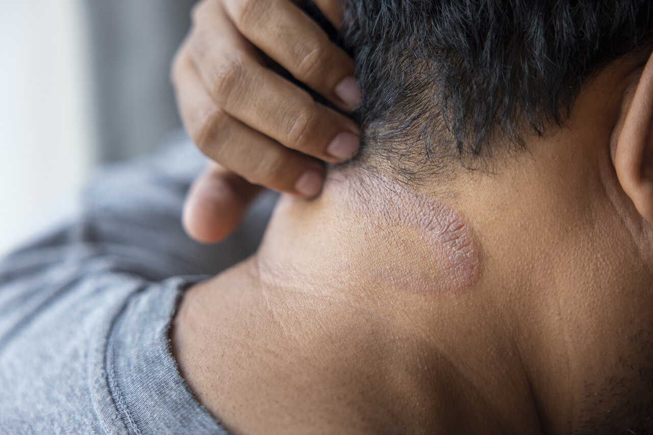 Psoriasis | MedCentral