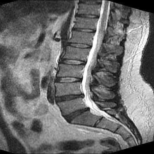 Case Report: Mid-Age Male with Chronic Low Back Pain