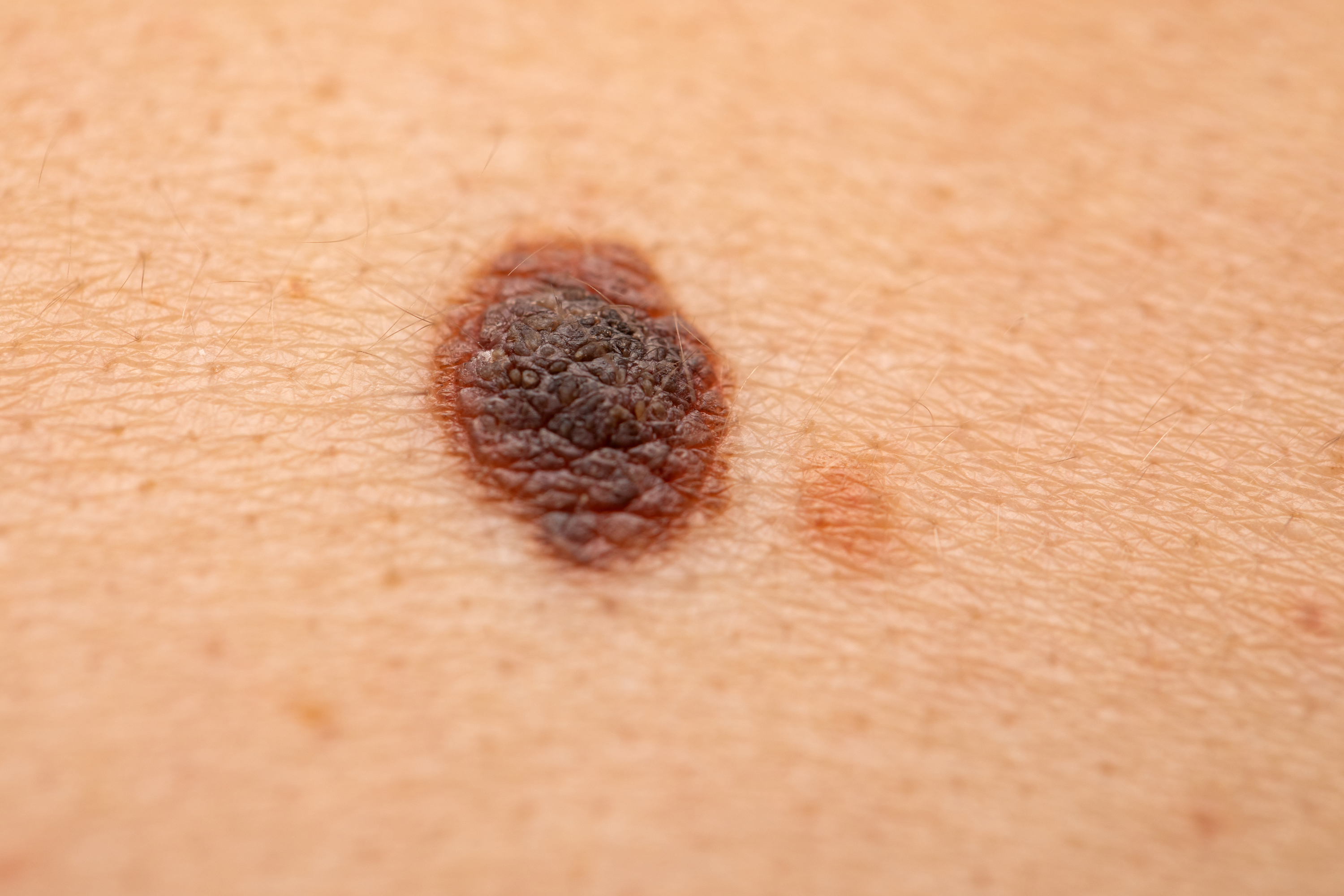 How to Identify Skin Cancer