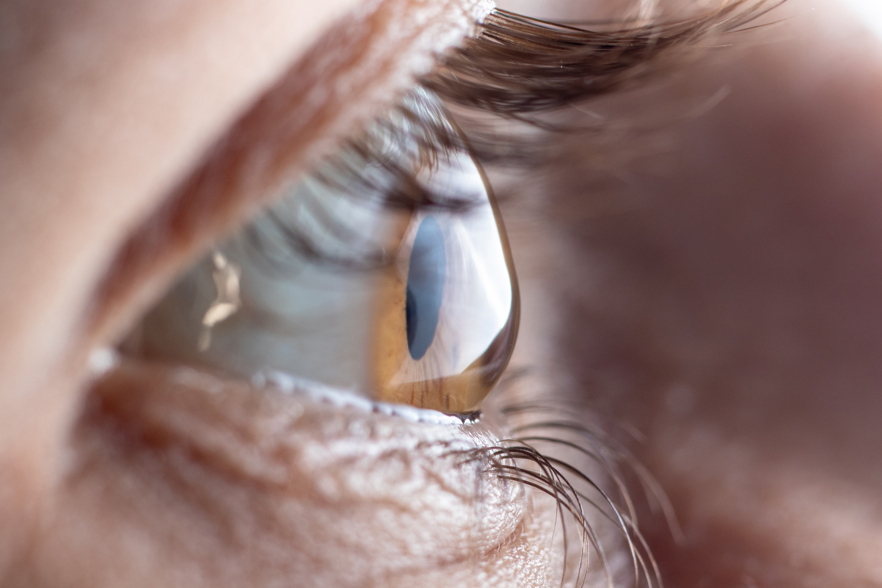 Teprotumumab Improves Outlook for Thyroid Eye Disease