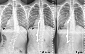 Pediatric Scoliosis Clinical Case Scenarios
