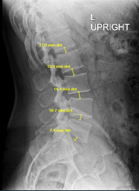 Case Report: Mid-Age Male with Chronic Low Back Pain