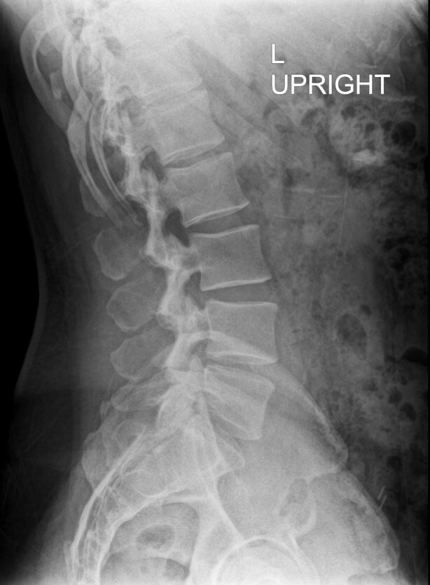 Case Report: Mid-Age Male with Chronic Low Back Pain