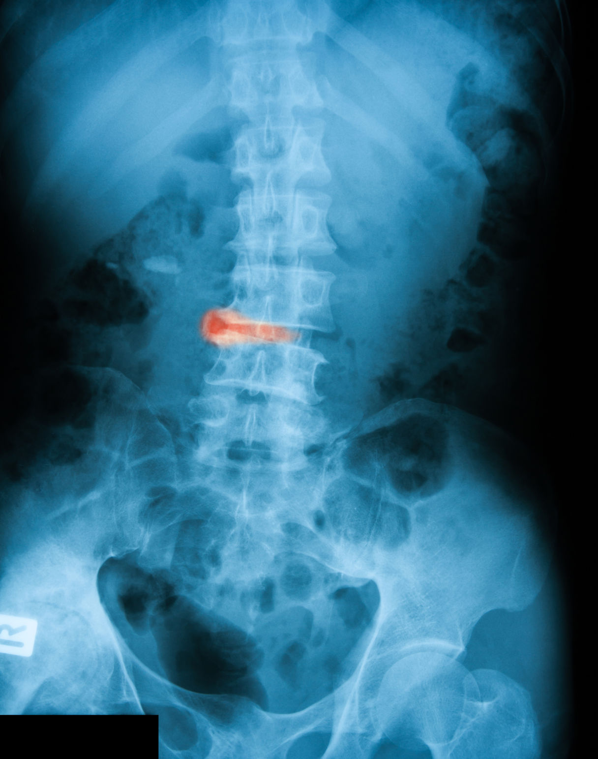 Axial Spondylitis: Mimics, Progression, the Need for MRI, and New ...