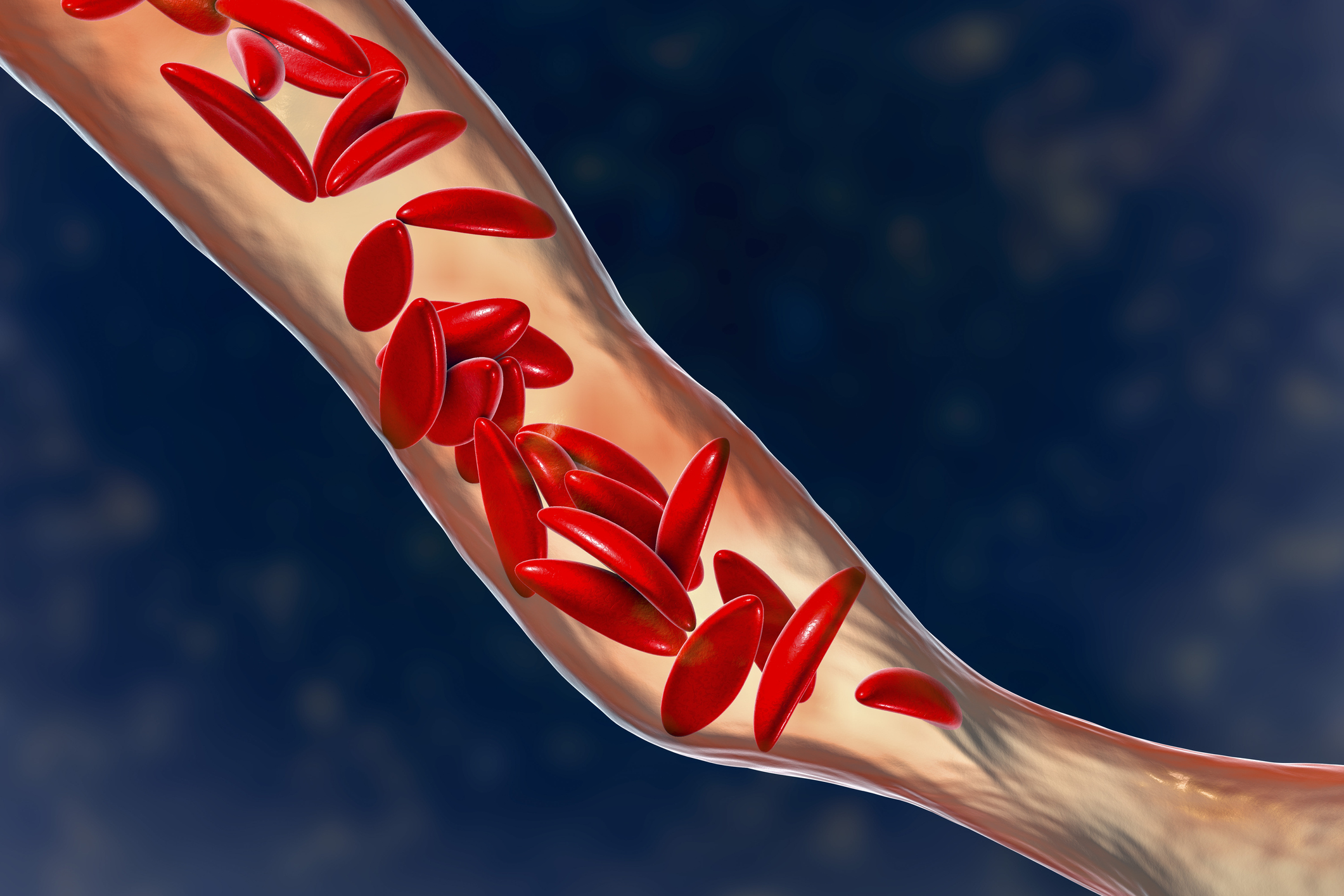 The Complexity of Sickle Cell Pain