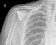 Shoulder Replacement Surgery Treatment Advances And Alternatives