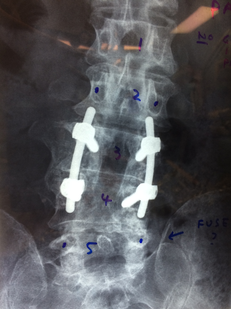 Back Pain Treatment: Is Spinal Fusion Surgery Being Overused?