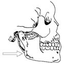 Temporomandibular Joint Disorder Mimic Ernest Syndrome Diagnosis and ...
