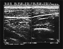 Trigger Point Low Level Laser Therapy