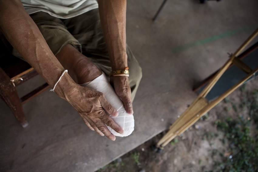 Mitigating Phantom-Limb Pain With Electric Cell Signaling—A Case Report