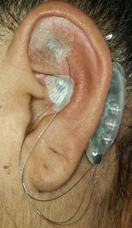 Percutaneous Electrical Neurostimulation For Detoxification In Opioid ...