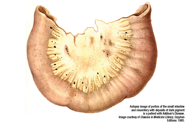 Addison’s Original 1855 Cases Reveal Stories of Chronic Pain