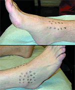 Dextrose Prolotherapy Injections for Chronic Ankle Pain