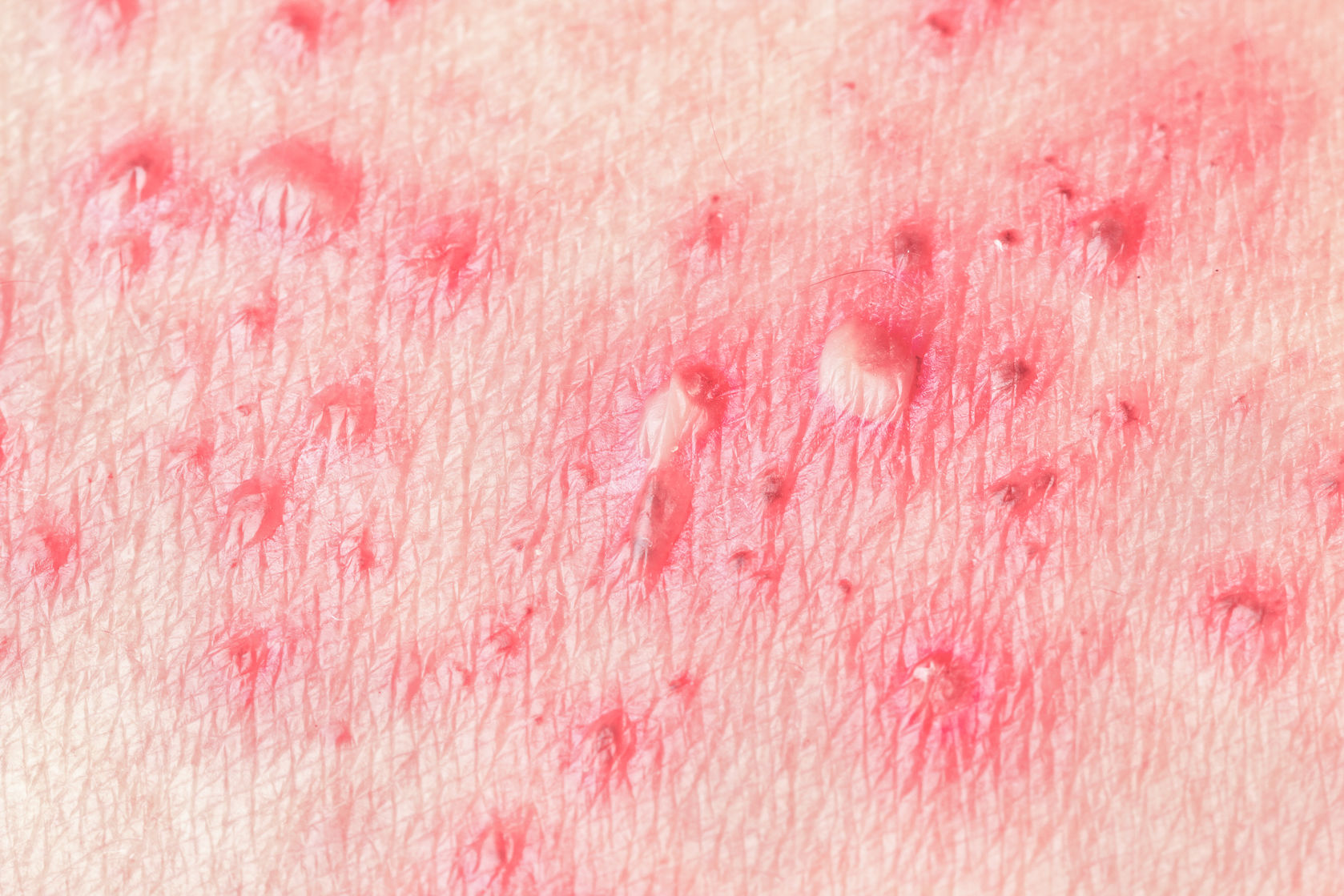 Emerging Treatments for Postherpetic Neuralgia, Shingles