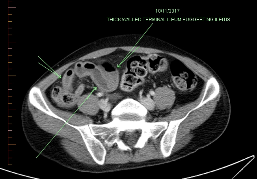 Intravenous Stem Cell Administration for Ileitis