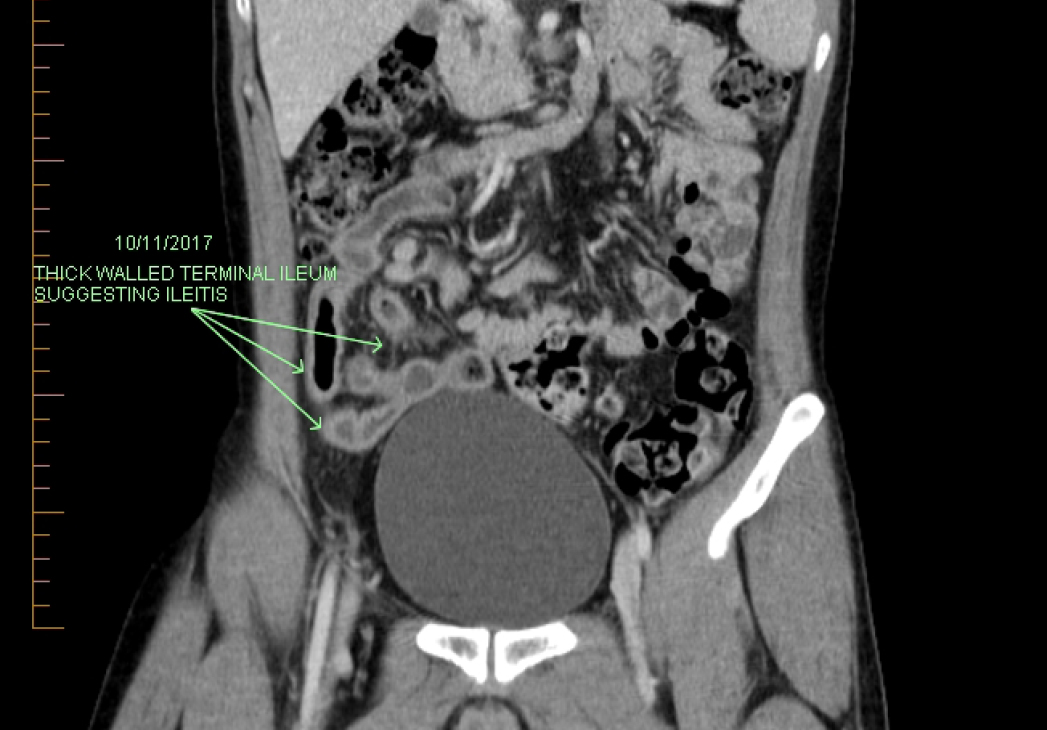 Intravenous Stem Cell Administration for Ileitis