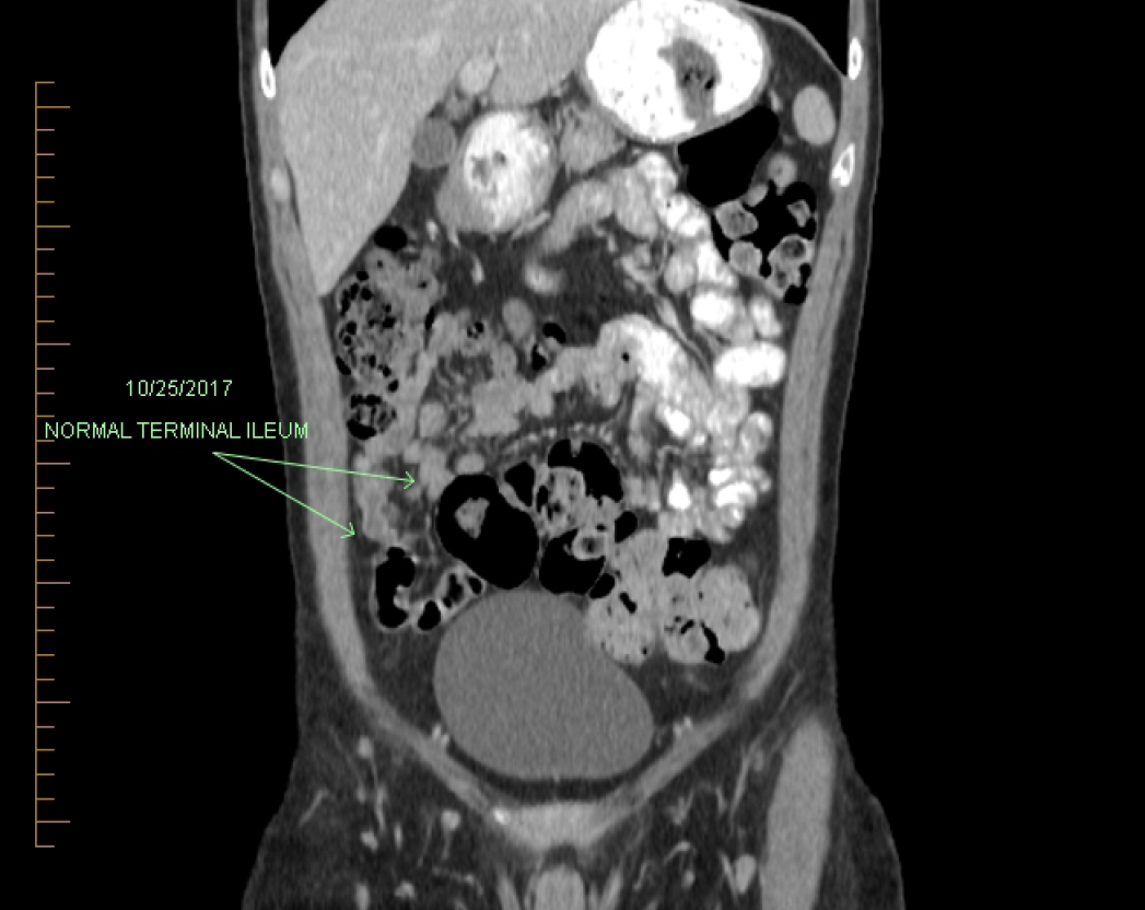 Intravenous Stem Cell Administration for Ileitis