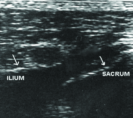 Evaluation and Management of Sacroiliac Joint Dysfunction
