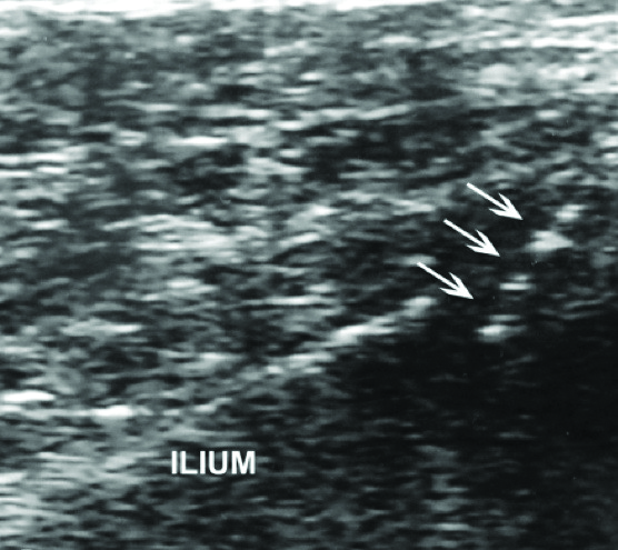 Evaluation and Management of Sacroiliac Joint Dysfunction