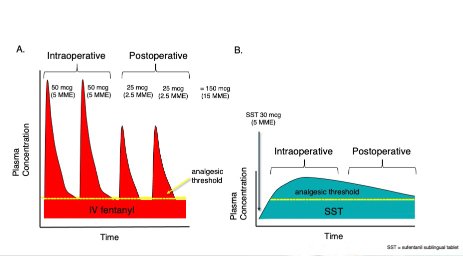 Fentanyl, Sufentanil (Dsuvia), and Pain Management After Surgery: A New ...