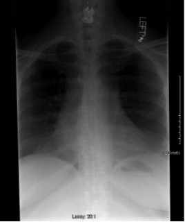 Spinal Cord Stimulation: A Case of Extreme Lead Migration