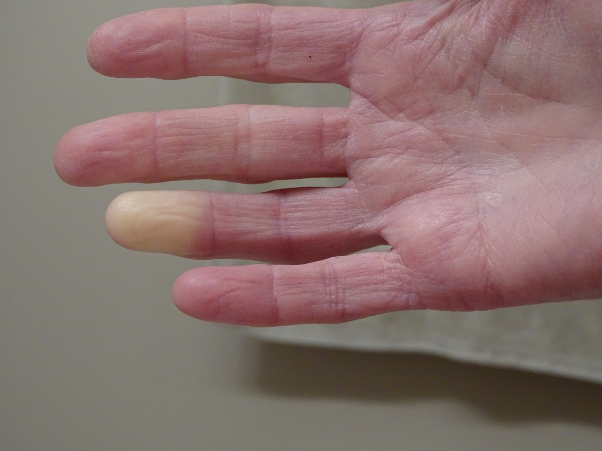 Scleroderma, Raynaud’s Phenomenon, and Differential Diagnoses