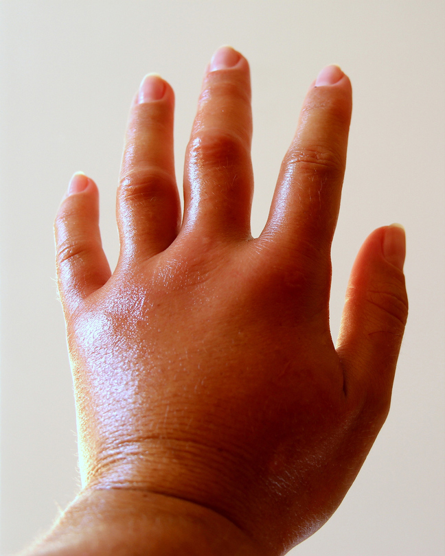 Scleroderma, Raynaud’s Phenomenon, and Differential Diagnoses