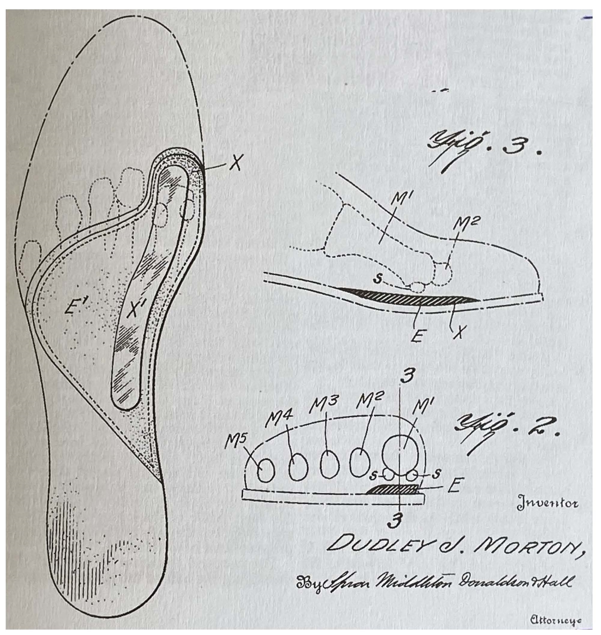 Morton’s Toe and Chronic Pain