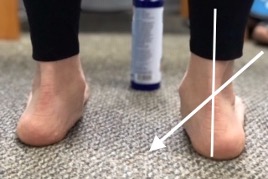 Morton’s Toe and Chronic Pain