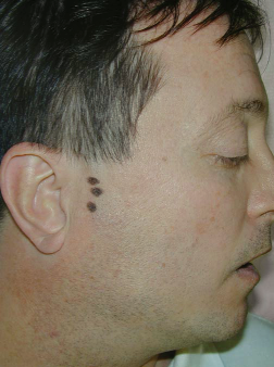 Dextrose Prolotherapy and Pain of Chronic TMJ Dysfunction